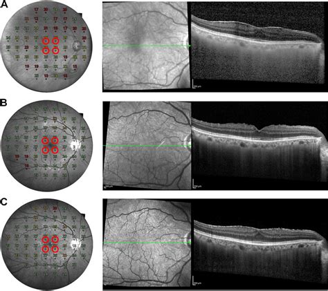 A Representative Case Of Recurred Epiretinal Membrane Erm After Download Scientific Diagram