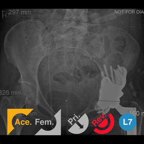 Case 10 Revision Of A Metal On Metal Hip With Massive Acetabular Osteolysis And Previous