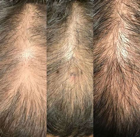 Exosomes Hair Loss Treatment Aestha Clinic