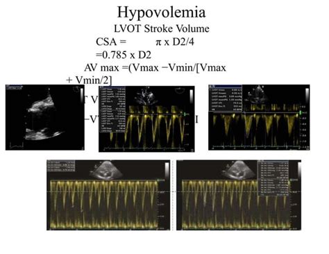 Basics Of Tte And Tee Trans Esophageal Echo Pptx