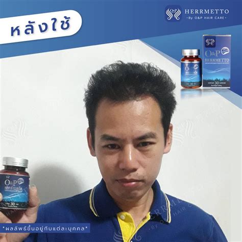 🔥อยากให้ลอง ใช้ดีเห็นผลจริง ลดผมร่วง Oandp Hair Care B4