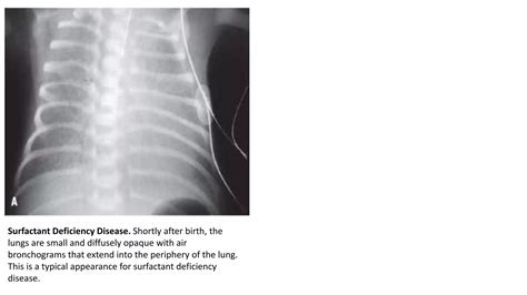 Thoracic Radiological Signs Pptx Lung And Respiratory Health Diseases And Conditions