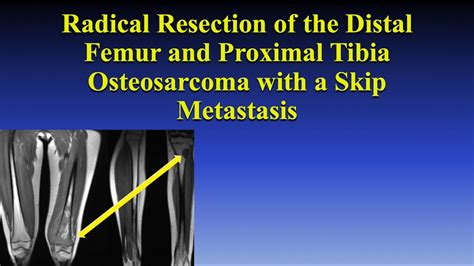 Proximal Tibia