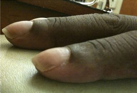 Abnormal Fingernails
