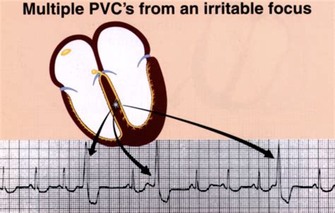 EKG Flashcards Quizlet