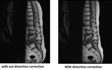 gradient non linearity artifact image distortion artifact