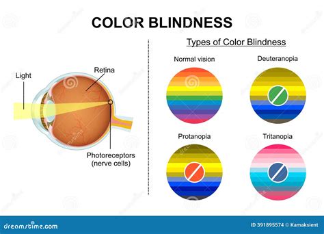 Color Blindness Or Colorblindness Normal Vision Protanopia