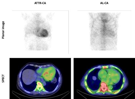Cardiac Uptake Of M Tc PYP In Patients With Cardiac Amyloidosis The Download Scientific