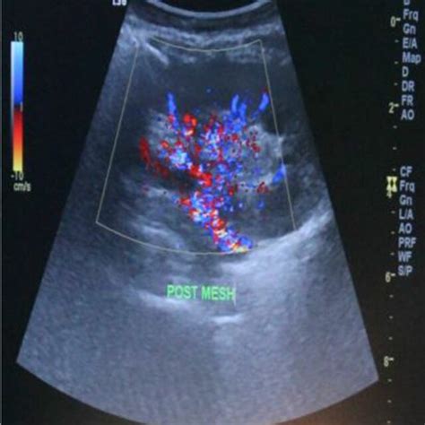 Ultrasound Evaluation Results Of Recipient After Mesh Insertion