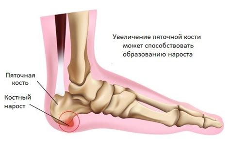 Упражнения от пяточной шпоры - метод Бубновского