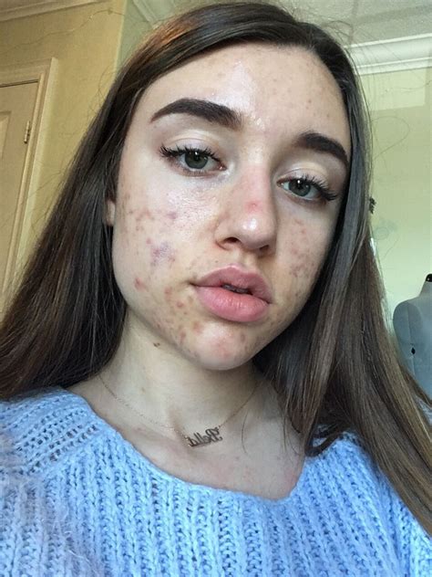 Pretty Gramunion Com Facingyourscars Tumblr Com Sensitive Skin Treatment Sensitive