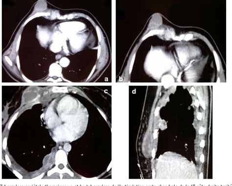 Figure 1 From Surgery For Thoracic Tuberculosis Semantic Scholar