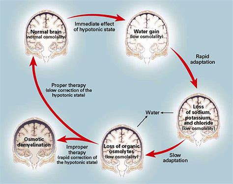 How To Deal And Prevent Overcorrection Of Hyponatremia How To Deal And Prevent Overcorrection Of Hyponatremia