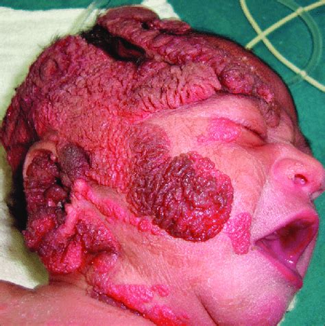 Cerebriform Nevus Sebaceous At Right Scalp Face And Neck Download Scientific Diagram