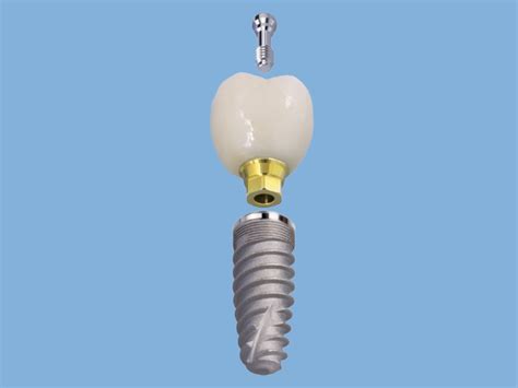 Implant Restorations Screw Retained Vs Cemented Crowns
