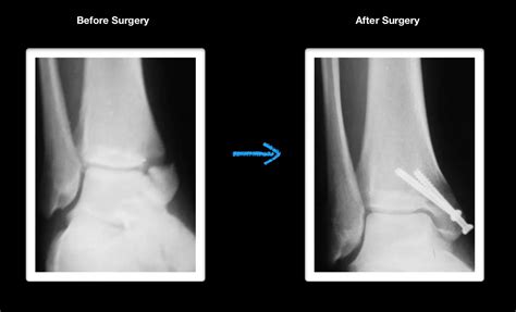 Medial Malleolar Fractures Robert Sheinberg Dpm Weston Fl Podiatrist