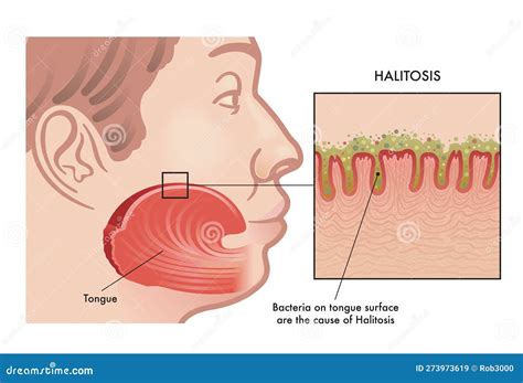 Halitosis Bacteria On Tongue Cartoon Vector 273973619