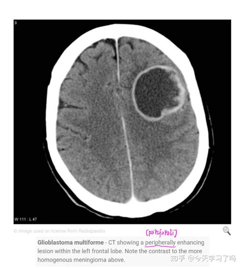 脑肿瘤brain Tumours（医学英语） 知乎