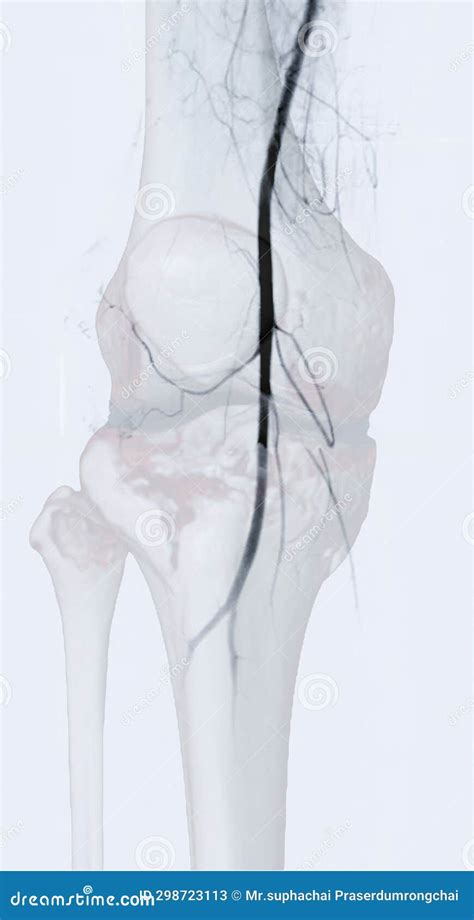 A Femoral Angiogram Is A Medical Procedure Used To Visualize Blood