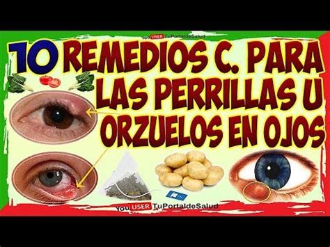 Como Curar Un Orzuelo O Perrilla De Los Ojos Rapidamente Con 10