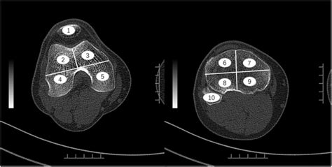 Application Of Double Layer Detector Spectral Ct Calcicum Supression