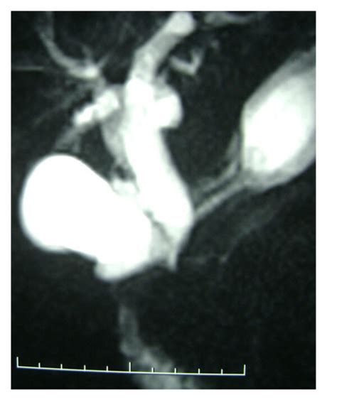 Mrcp Appearance An Mrcp Examination Reveals Dilated Whole Biliary Tree Download Scientific