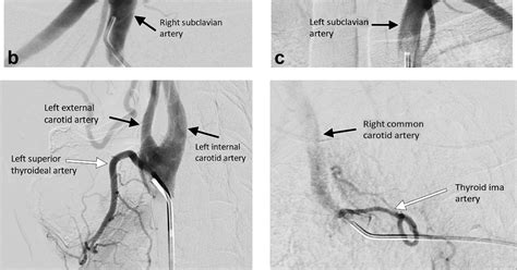 Jvir Access Thyroid Embolization For Nonsurgical Treatment Of Nodular