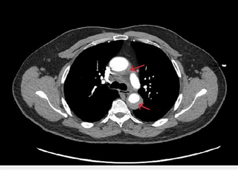 Ct Imaging Showing An Axial View Of The Intramural Hematoma Surrounding