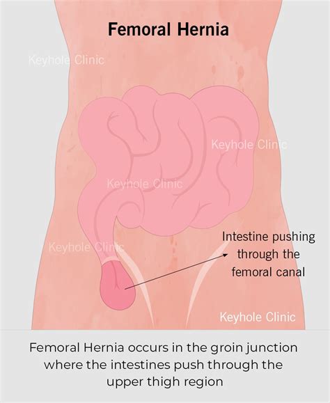 Femoral Hernia Symptoms Causes And Treatment