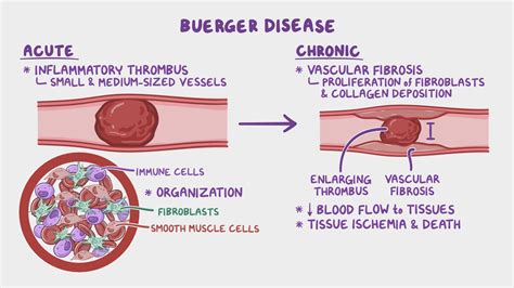 Buergers Disease Test At Gloria Klug Blog