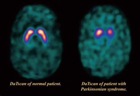 Datscan Procedure Information Cedars Sinai