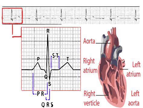 Che Cosa è Pacemaker Dddr