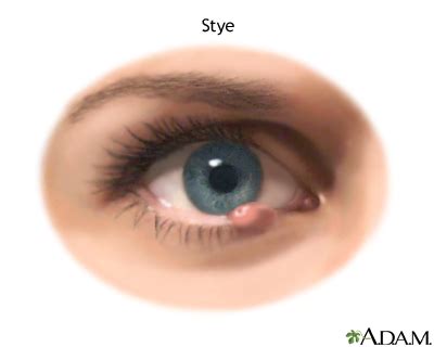 Eyelid Bump Medlineplus Medical Encyclopedia