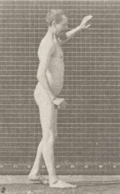 Nude Man With Locomotor Ataxia Walking With Both Arms Up And Down Rbm QP M C