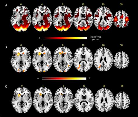 voxel based morphometry plos one