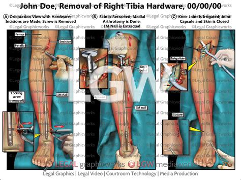 Removal Of Right Tibia Hardware Lgwgo