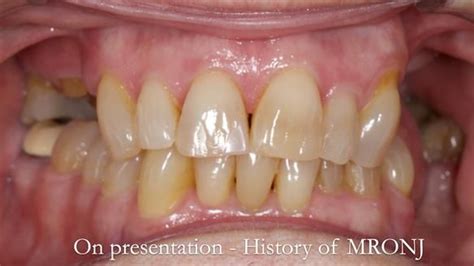 Finlays Newsletter 60 Sylvias Upper Kennedy Class 2 Mod 1 Metal Based Upper Rpd Finlay