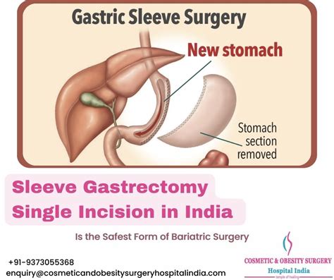 Cost Of Sleeve Gastrectomy Single Incision India Health Nigeria