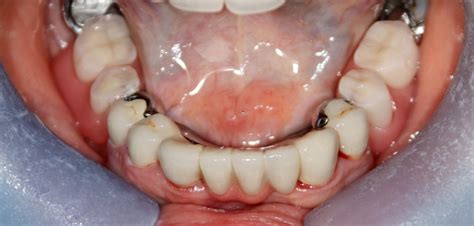 Precision Attachment Dentures Dental World