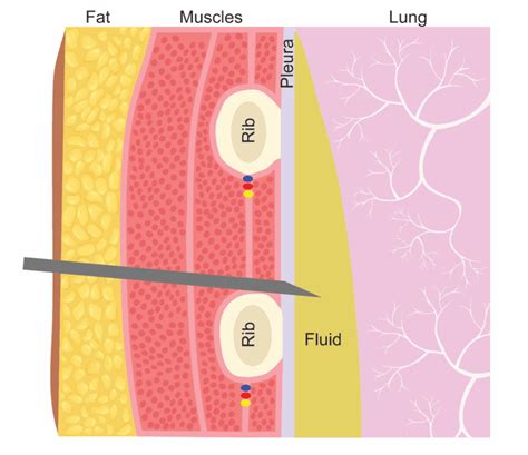 Rib Reverberation An Important New Artifact In Lung Ultrasound Pocus