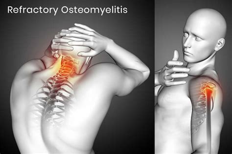 Hyperbaric Treatment Of Chronic Refractory Osteomyelitis Hyperbaric