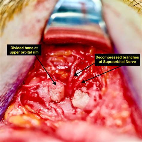 Supraorbital Nerve Decompression Photos Migraine Surgery