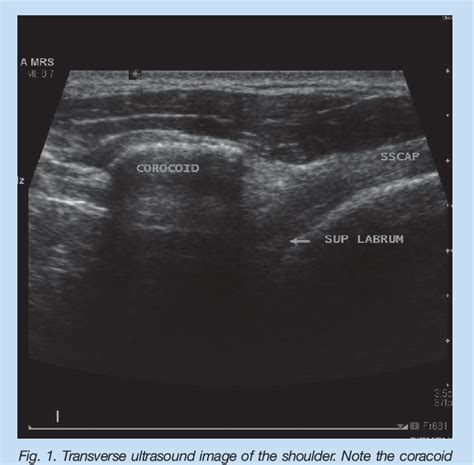 Figure 1 From Anterior Approach V Posterior Approach Ultrasound Guided Shoulder Arthrogram