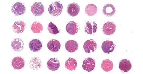 mc248 multiple tumor and normal tissue array with including tnm stage