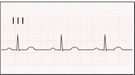 3 Lead Ecg Nursing Unraveled