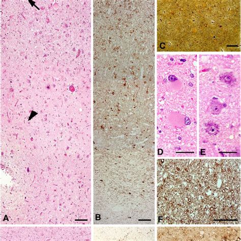 Balloon Cells Dysmorphic And Hypertrophic Neurons Presented Download Scientific Diagram