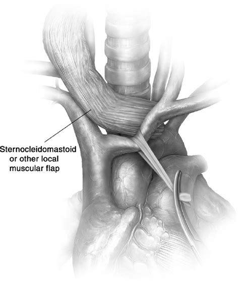 Management Of Tracheal Surgery Complications Semantic Scholar
