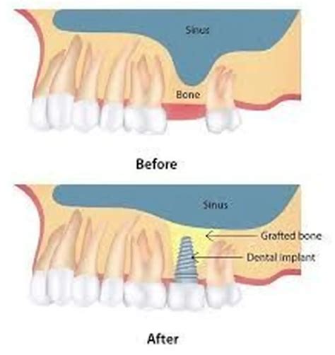 Sinus Lift In Londons No1 Clinic Dulwich Dental Office