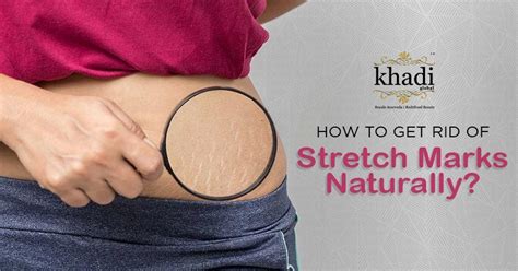 How To Get Rid Of Stretch Marks Naturally