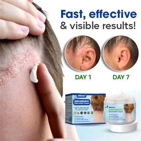 Seborrheic Dermatitis Cream Beautykomi